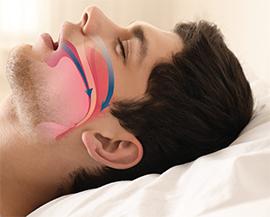 Sultiame shows therapeutic potential in obstructive sleep apnoea ...
