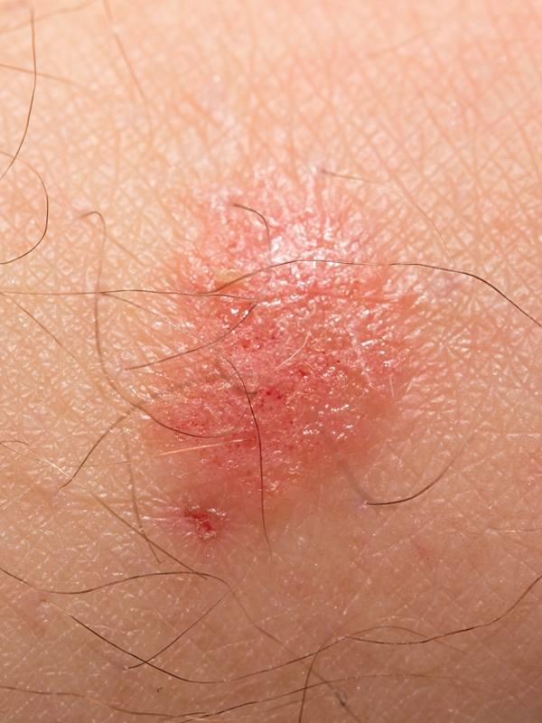 Tinea Cruris
