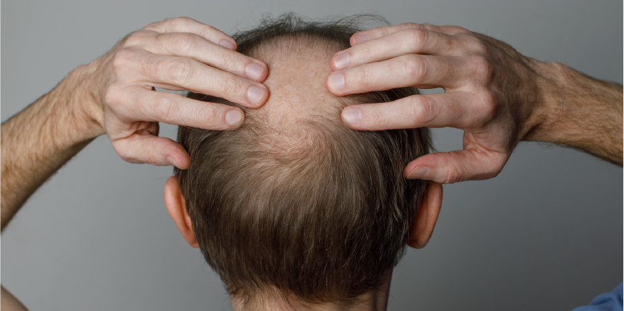 Alopecia : Initial Assessment | MIMS Thailand