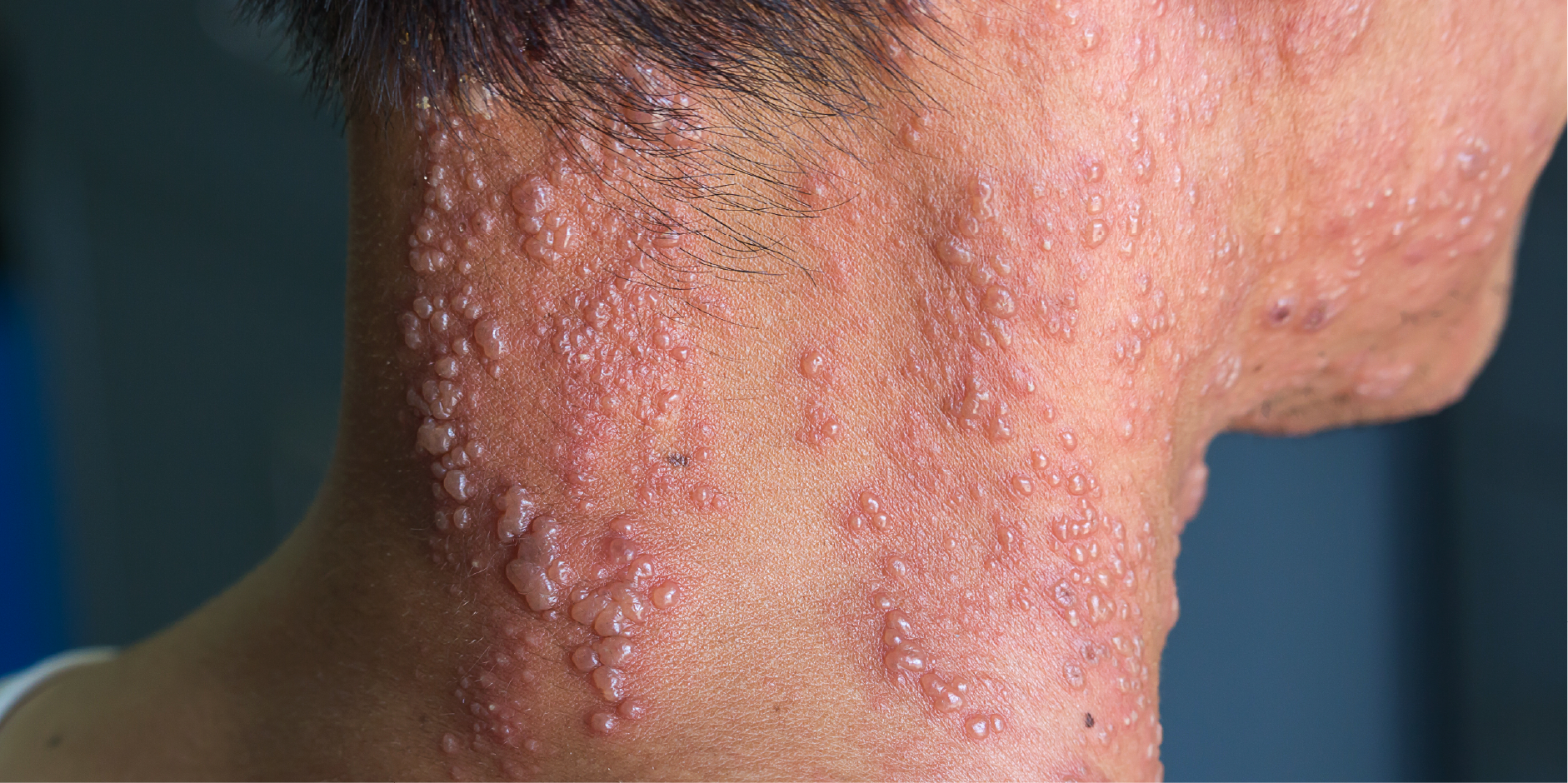 Varicella : Disease Summary | MIMS Indonesia