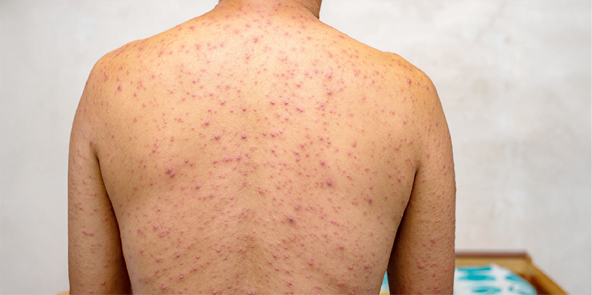 Varicella : Initial Assessment | MIMS Thailand