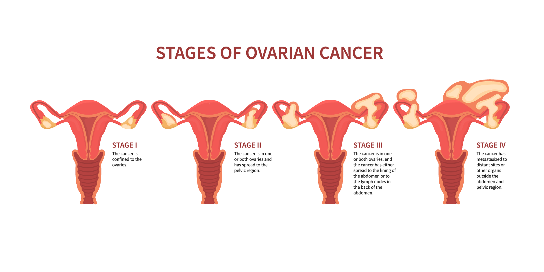 Ovarian Cancer : Management | MIMS Malaysia